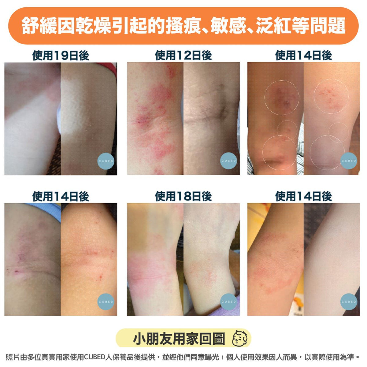 Cubed KIDS Body Butter 兒童紓緩潤膚霜 - 修護泛紅乾癢，更適合幼嫩脆弱敏皮膚或異位性皮膚炎寶寶 | 兒童濕疹肌、類固醇戒斷適用 | 用家回圖證實 | Cubed 為問題肌而生